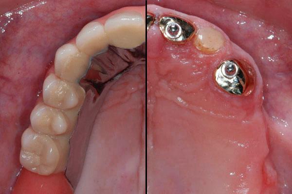© Klinik für Zahnärztliche Prothetik, Zahnmedizinische Kliniken der ...