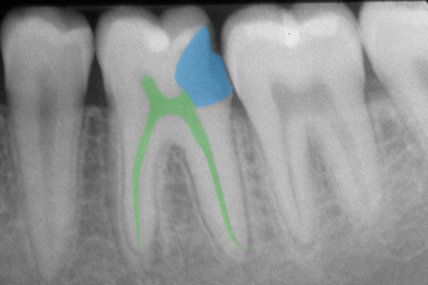 © Klinik für Zahnerhaltung, Präventiv- und Kinderzahnmedizin ...